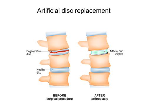 What You Need To Know About Cervical Disc Replacements | Midwest ...